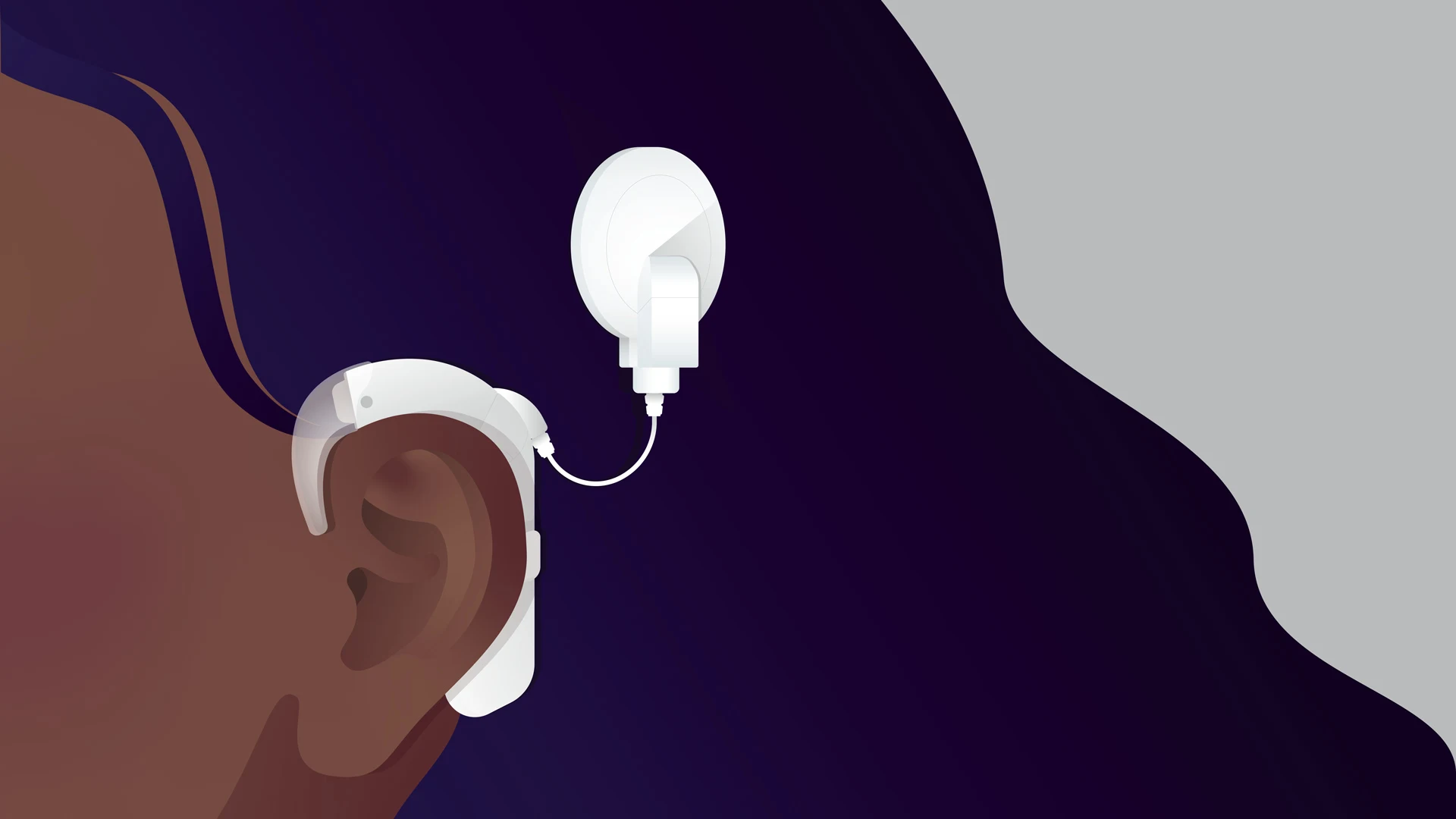 Cochlear implants can help restore hearing—but not for everyone