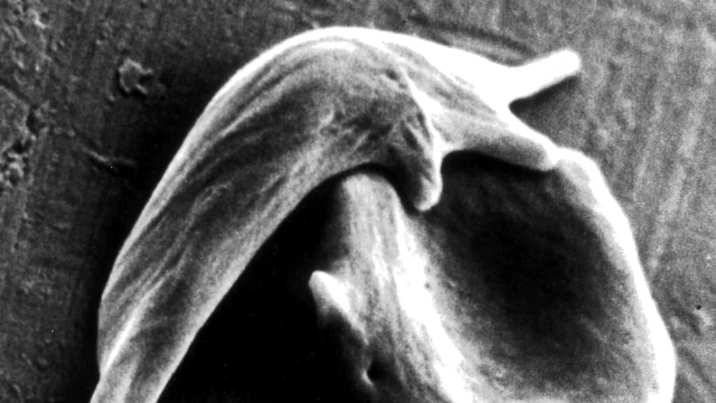 CRISPR Gene Editing Is Making Huge Strides In Curing Sickle Cell ...