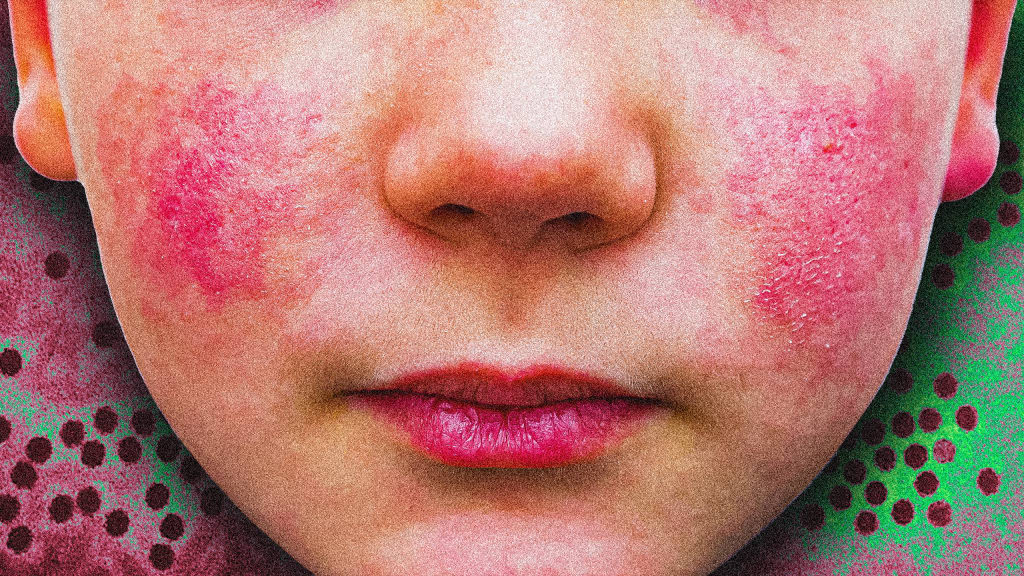 Parvovirus B19: symptoms, slapped cheek rash, virus cases rising - Fast ...