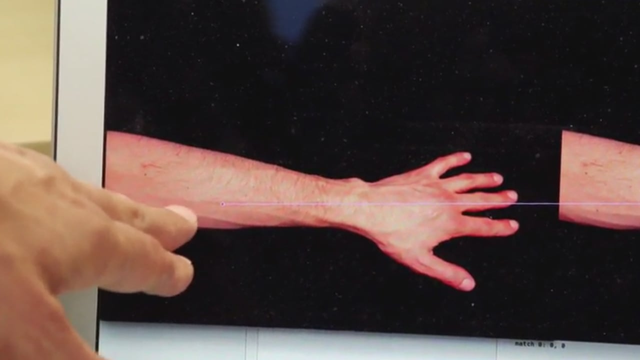 Mapping The Mole To Help Stop Skin Cancer - Fast Company