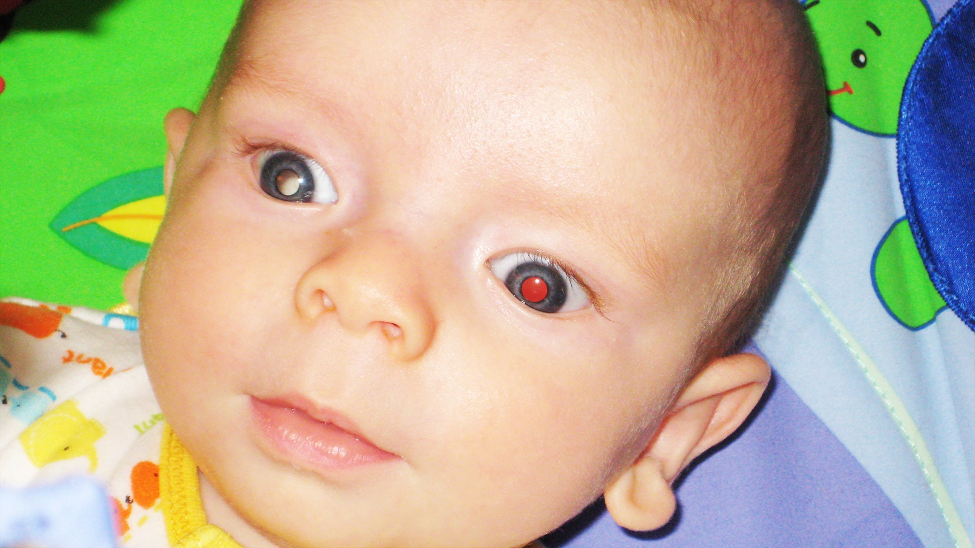 Diagnosing Cancer By Scanning The Family Photo Album For White Eyes ...
