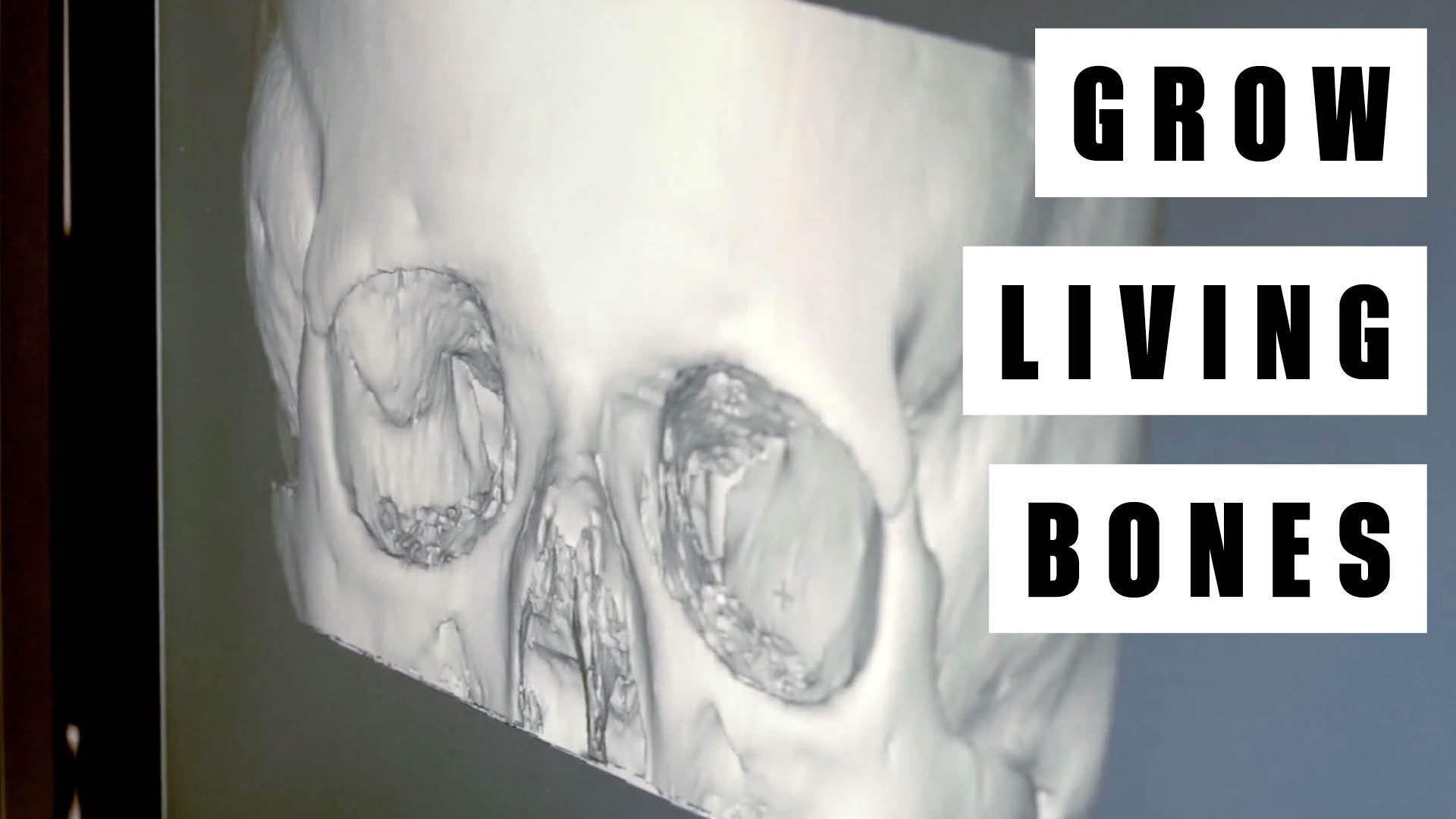 Need A New Bone? Grow It From Your Own Cells - Fast Company