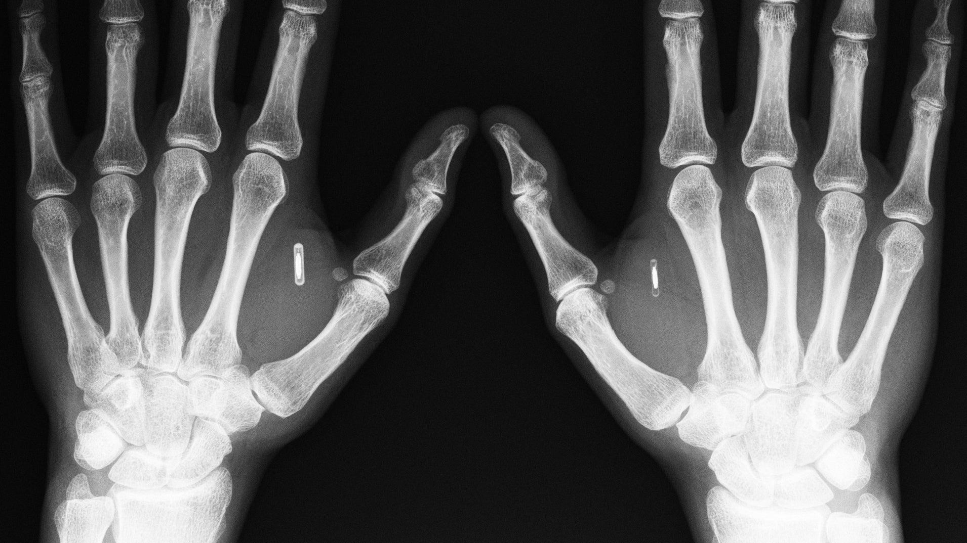 Under My Skin: The New Frontier Of Digital Implants - Fast Company