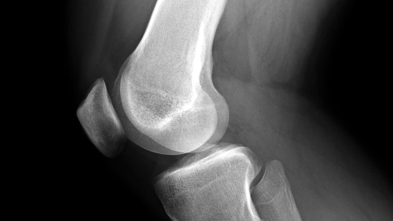 3D-Printed Hyperelastic Bone Is Like Duct Tape For Bone Surgeons - Fast ...