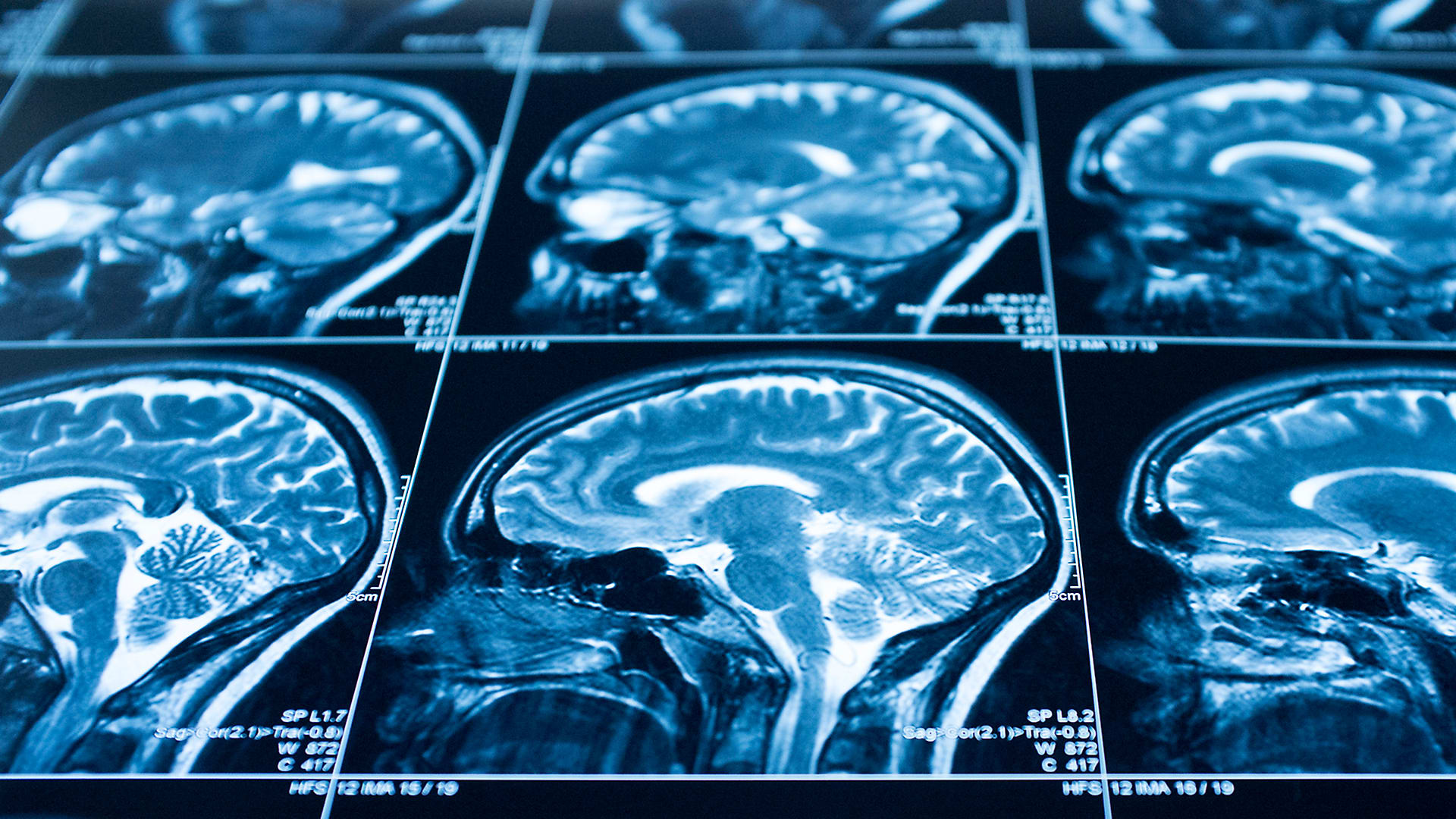 Facebook and NYU are using AI to dramatically speed up MRI imaging ...