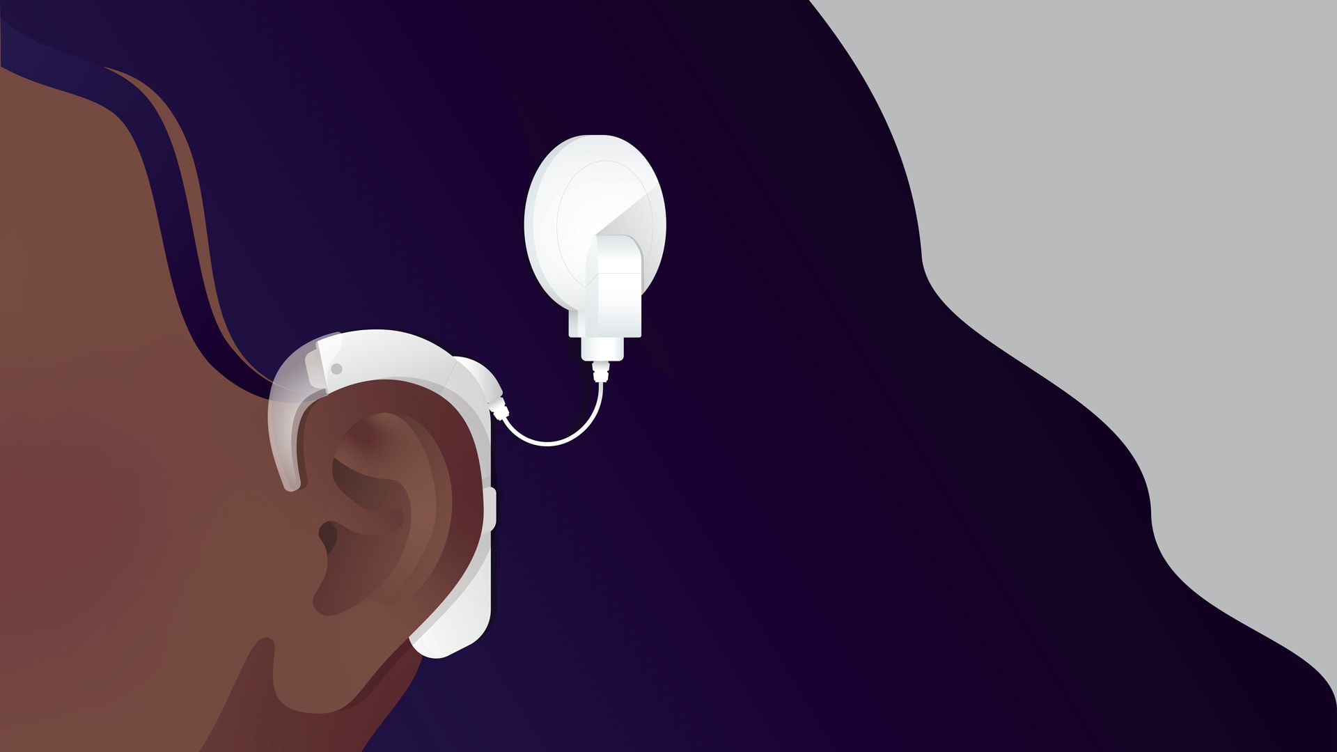 Cochlear implants can help restore hearing—but not for everyone