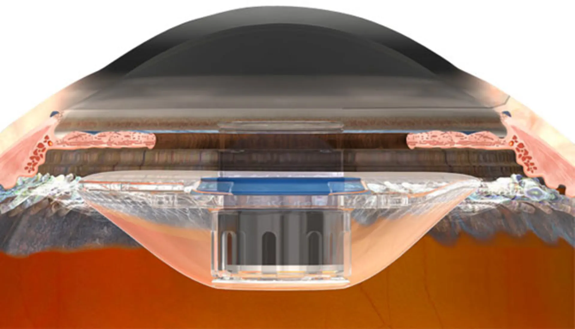 Fighting Blindness With Telescope Implants - Fast Company