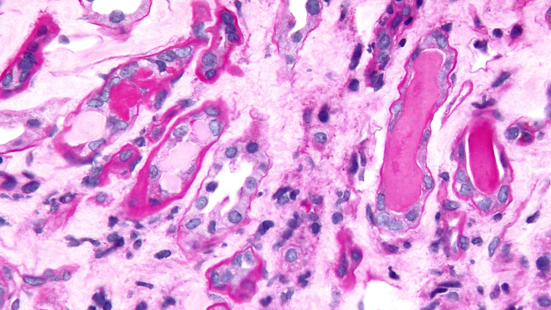 This rare cancer is paving the way for breakthroughs for other forms of ...