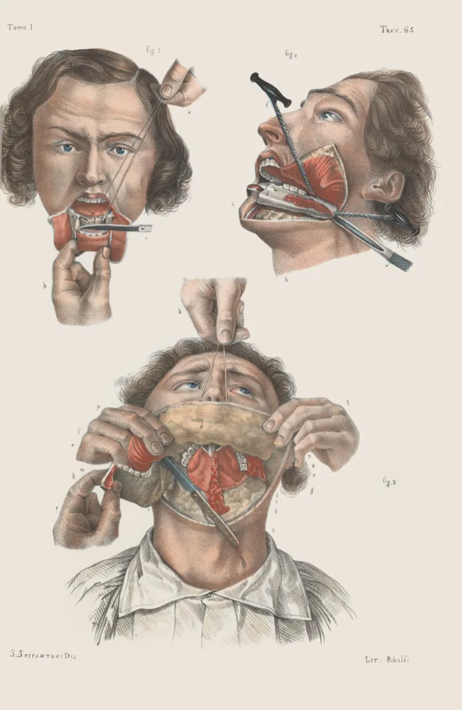 The Morbid History Of Victorian Surgery, Beautifully Illustrated - Fast ...