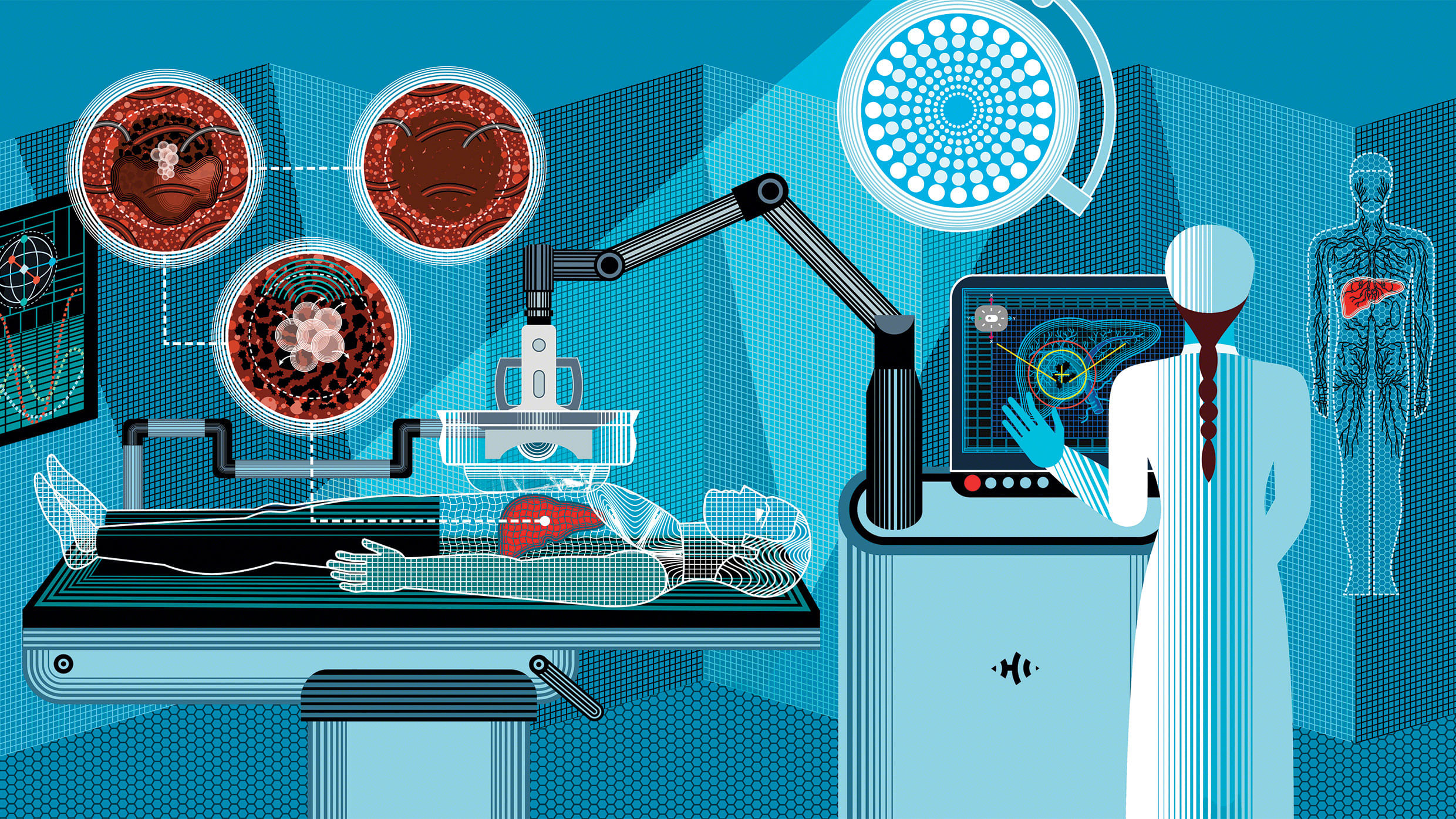 How HistoSonics liquefies liver tumors with ultrasound waves - Fast Company
