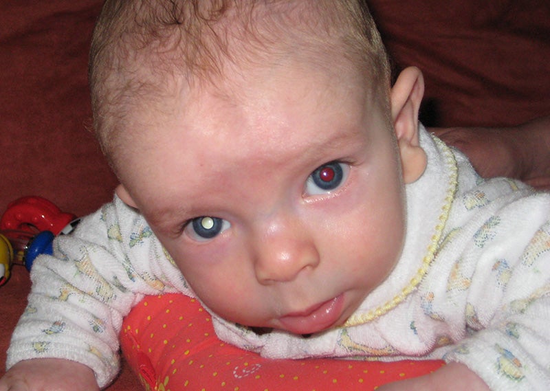 Diagnosing Cancer By Scanning The Family Photo Album For White Eyes ...