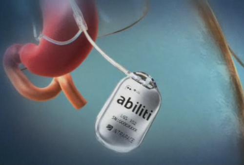 Obesity Shocker: Pacemaker Zaps Stomach Internally to Prevent ...