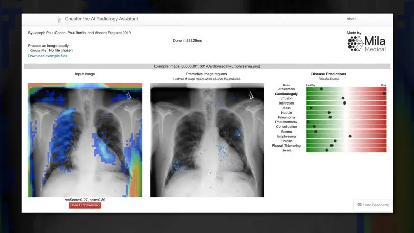 This free AI reads X-rays as well as doctors