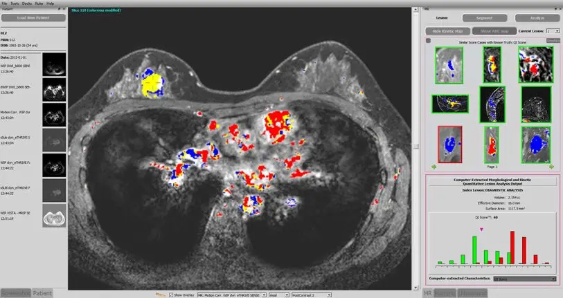 This AI breast cancer diagnostic tool is the first to get FDA clearance ...